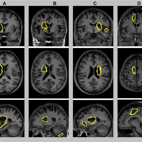 A Gm Wm And Csf Priors As Predefined In Spm5 Segmentation Into Gm