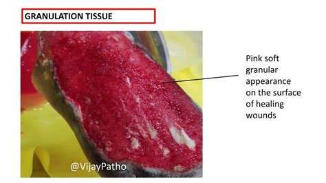 Granulation Tissue Pathology Made Simple