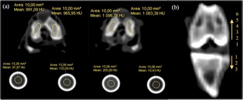 Ct Scans For Bmd Measurements A Sample And Phantom Setup With Rois Download Scientific
