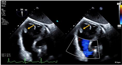 Transthoracic Echocardiogram Tte Centered At The Pulmonic Valve