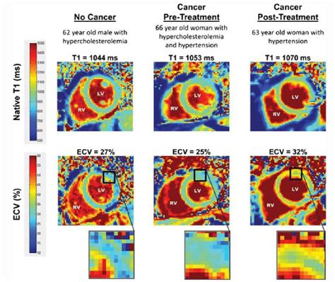 Figure 2 From The Role Of Cardiovascular Magnetic Resonance Imaging In
