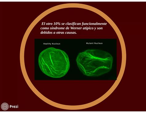 Prezi Sindrome De Werner Pdf