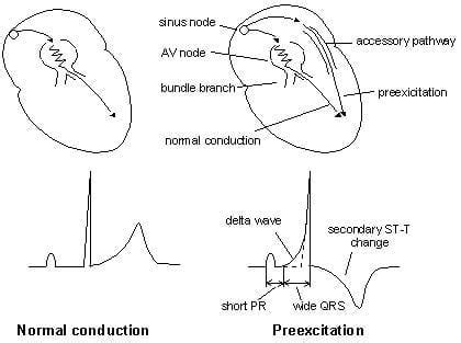 Pre Excitation Syndromes LITFL ECG Library Diagnosis