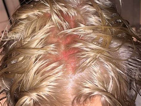 Irritated With Your Burning Scalp Heres How To Deal With It
