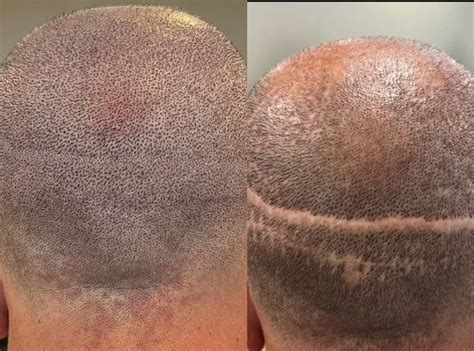 Micro Scalp Pigmentation Garden City Hair Without Surgery Islandia