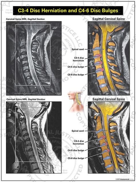 C3 4 Disc Herniations And C4 6 Disc Bulges Radiology Illustration