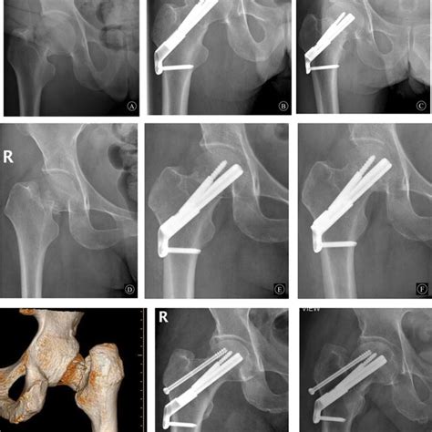 A B C Are 53 Year Old Men A Preoperative Hip Orthogonal Position