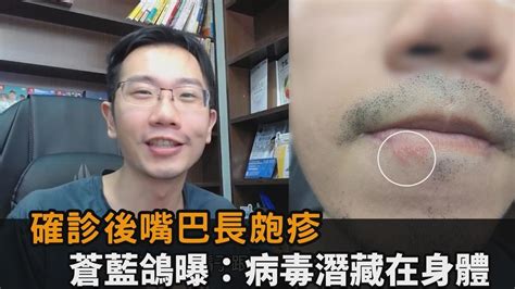 免疫力下降確診後嘴巴突然長皰疹 蒼藍鴿無奈曝它一直潛藏在身體內民視新聞 YouTube