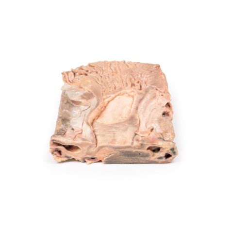 Chronic Gastric Ulcer Australian Physiotherapy Equipment