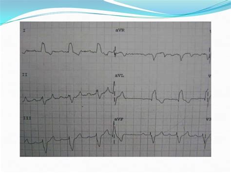 Ecg Trifascicular Block Pptx Ecg Trifascicular Block Pptx