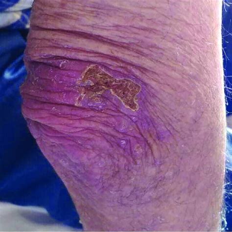 Erythematous Ulcerous Lesion Of The Elbow Download Scientific Diagram