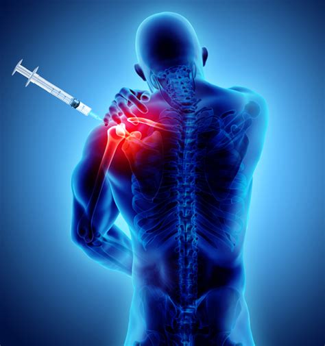 Suprascapular Nerve Block Genesis