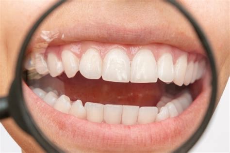 Enamel Microabrasion Before And After Cosmetic Smile
