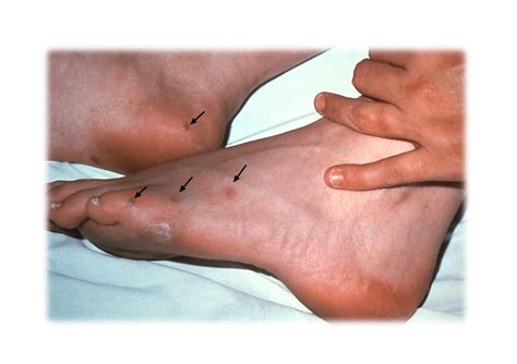 Core Concepts Gonococcal Infections Self Study Lessons National