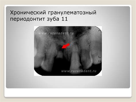 Воспалительные процессы челюстно лицевой области презентация онлайн