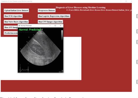 Figure 1 From Diagnosis Of Liver Diseases Using Machine Learning Algorithms And Their Prediction