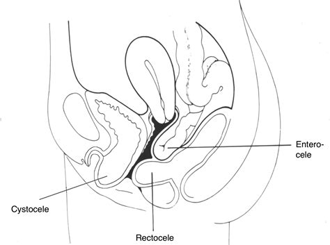 Vaginal Mesh Sydney Urodynamic