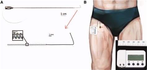 Percutaneous Peripheral Nerve Stimulation A A Preloaded