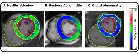 Oxygenation Sensitive Cardiac Mri With Vasoactive Breathing Maneuvers For The Non Invasive