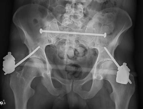Acute Management The Bone School