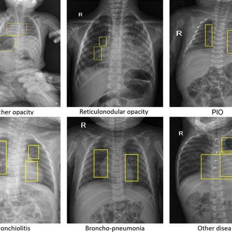 Several Representative Pediatric CXR Images For No Finding And Other Download Scientific