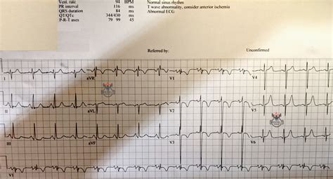 Stat Ecg Diagnoses Ecg Findings Of Cardiac Syncope What You Need To Look For What You Cant