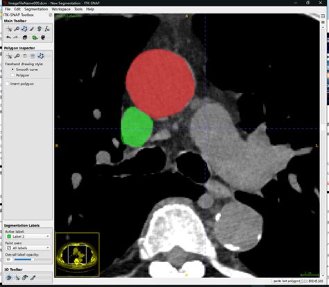 Itk Snap医学图像标注方法（超级详细）——保姆级itk Snap Csdn博客
