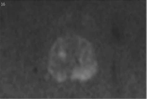 Assessing Extraprostatic Extension With Multiparametric Mri Of The
