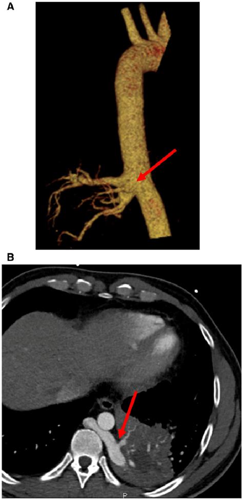 A Volume Rendering Technique Angio Ct Of The Large Arterial Supply Of