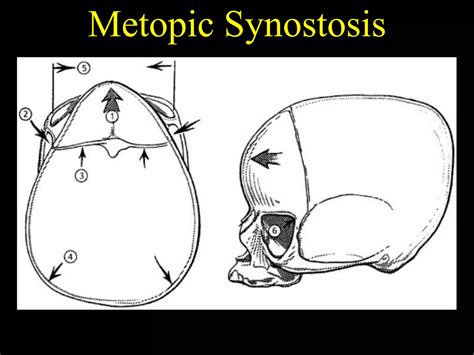 Craniosynostosis Pptx