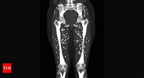 Craziest Ct Scan Reveals Tapeworm Cysts In Patients Legs Know Why
