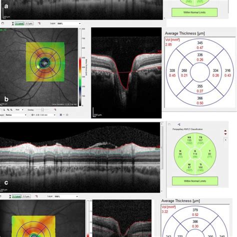 Peripapillary Retinal Nerve Fiber Layer Thickness A And Peripapillary Download Scientific