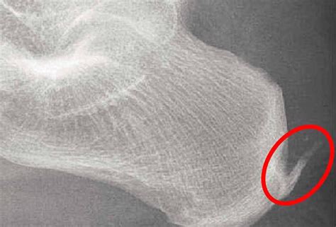 Calcific Achilles Tendonitis Causes And Treatment