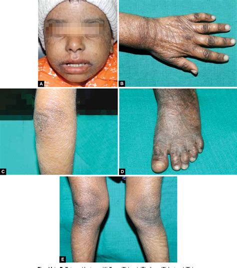 Congenital Ichthyosis Erythroderma