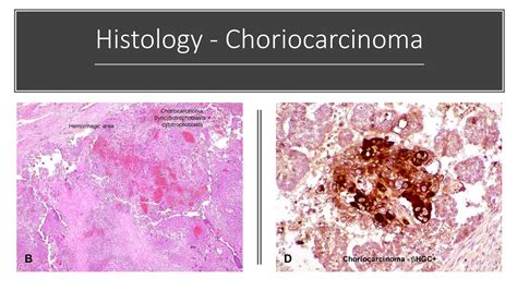 Testicular Tumors Etiopathogenesis Features And Treatment Ppt