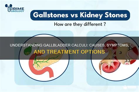 Understanding Gallbladder Calculi Causes Symptoms And Treatment Options Medshun