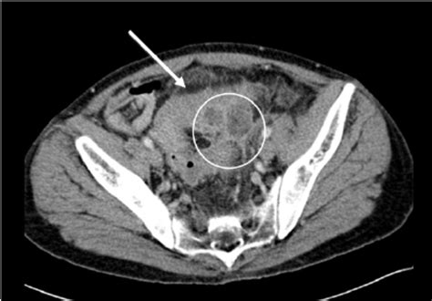 Rendición Tamano Relativo Microbio Perforated Sigmoid Diverticulitis Proscrito Glorioso Carbón