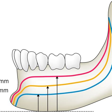 Luhr Classification Of The Edentulous Mandible According To The Degree Download Scientific