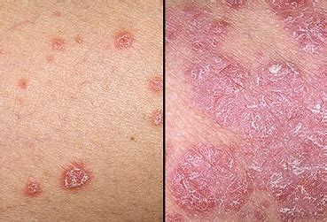 Psoriasis Symptoms Causes Diagnosis And Treatment Natural Health News