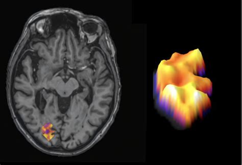 New Biomarker For Predicting Progression Of Multiple Sclerosis Identified