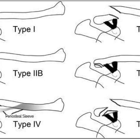 Universal Classication System Of Clavicle Fractures Robinson Et Al 1 Download Scientific