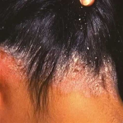 Best Images About Disorders Of The Scalp Hair On Pinterest Cosmetology Cradle Cap And