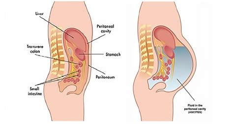 Anatomy Of The Peritoneum And Peritoneal Cavity Osmosis 55 Off