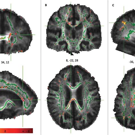 DTI Scan From J G As Compared With The Reference Group Of 10 Age And Download Scientific