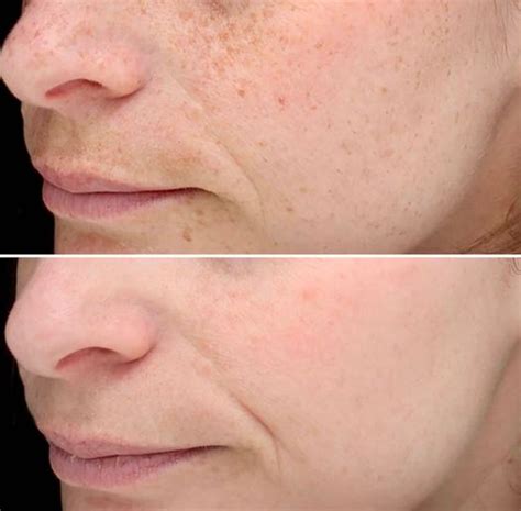 Pico Genesis Sharkra Medi Spa