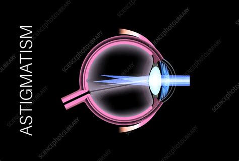 Astigmatism Eye Condition Illustration Stock Image F0438394
