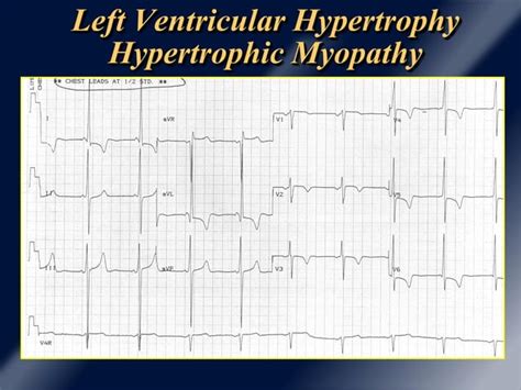 Pediatric Egc Interpretation Overview Of Pediatric Ecg Pdf