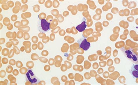 Pathogenesis And Clinical Features Of Lgl Leukemia — Loughran Lab At Uva