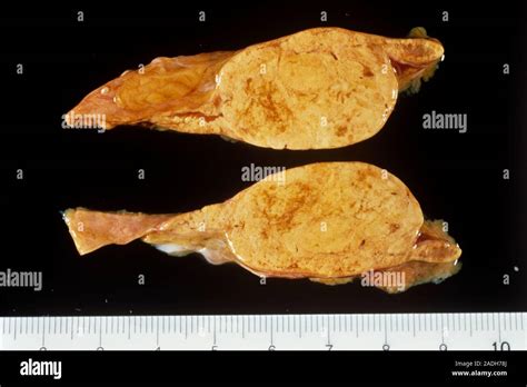 Adrenal Gland Tumour Gross Specimen This Is An Adenoma Of The Cortex