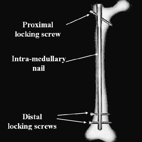 Femur Intra Medullary Nailing Download Scientific Diagram